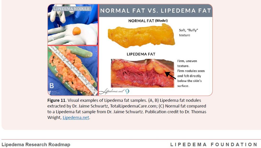 Kristin Osborn's Newcastle Lymphoedema & Lipoedema Clinic | Lipoedema