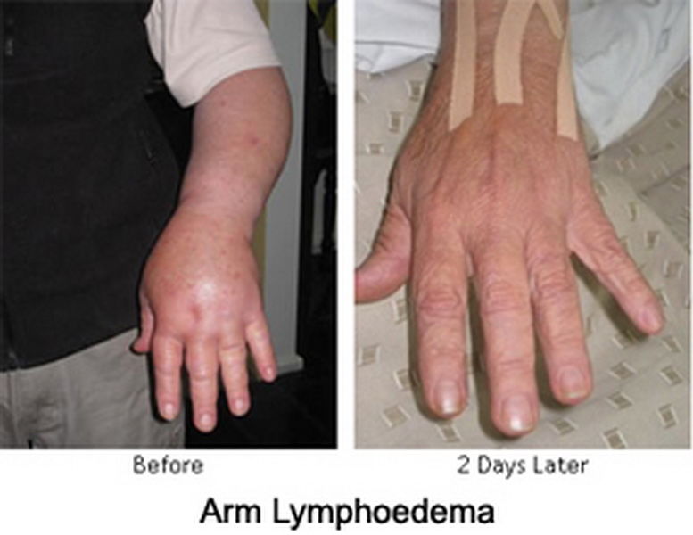 Kristin Osborn's Newcastle Lymphoedema & Lipoedema Clinic | Home